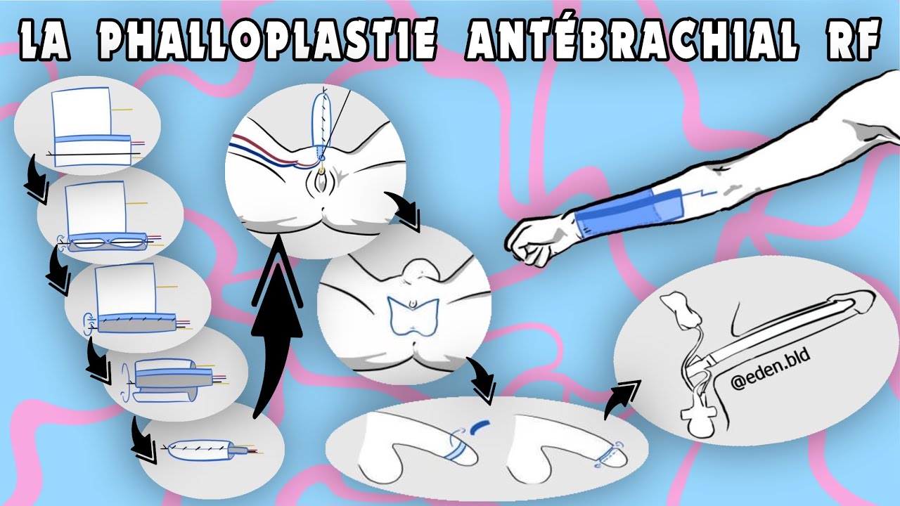 Phalloplastie antébrachial RF// Ftm transgenre français - YouTube
