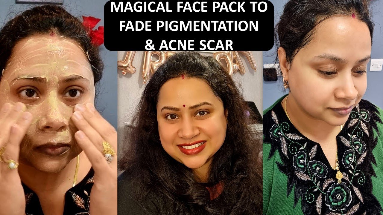 Pigmentation, Melasma & Acne Scar Treatment at Home | Natural Home ...