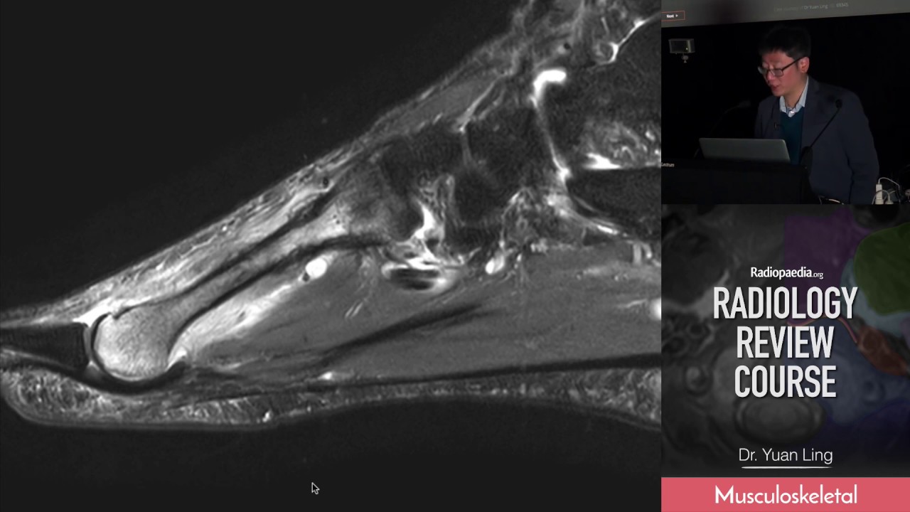 Stress Fracture Mri Metatarsal Stress Fractures | Bayside Standing MRI