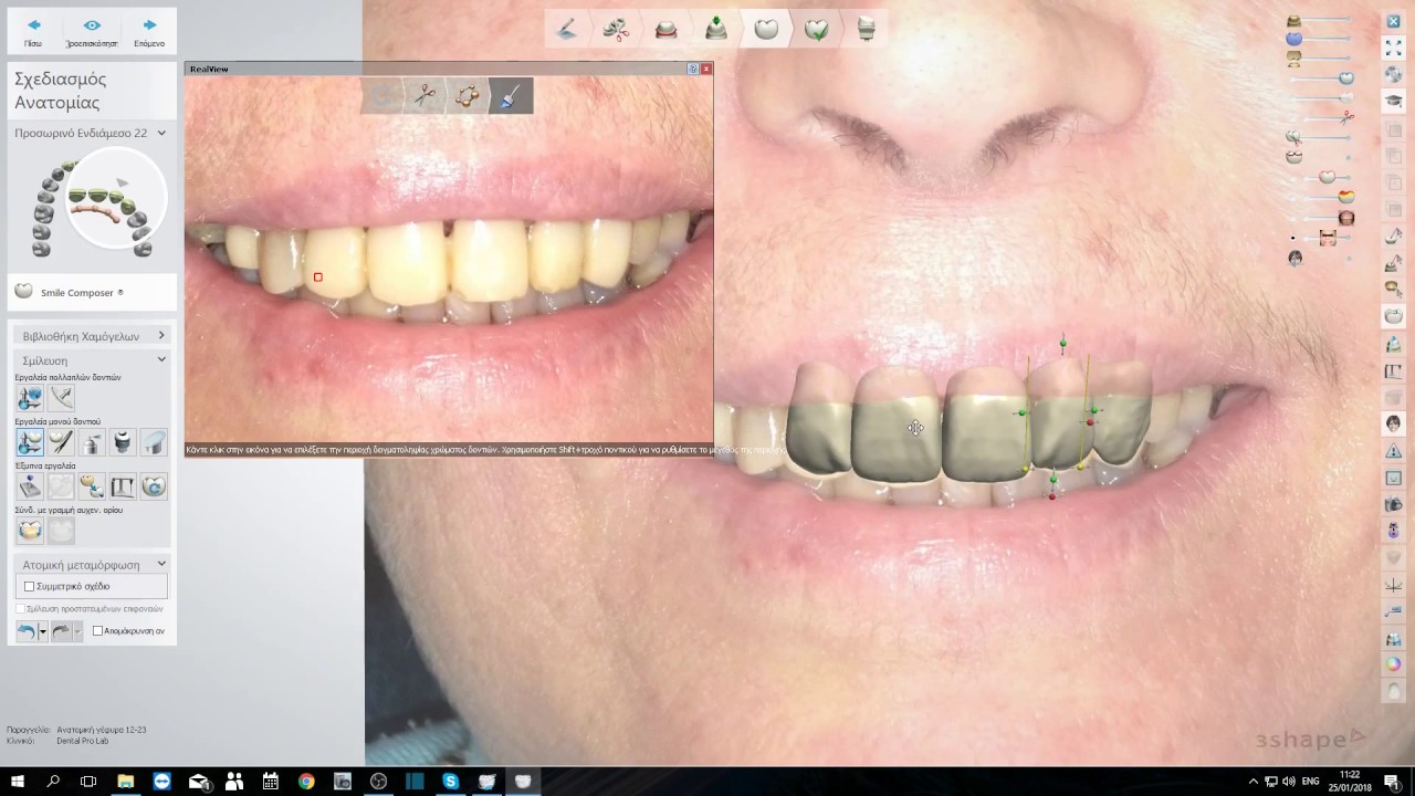 DLP 3Shape Digital Wax Up Design - YouTube