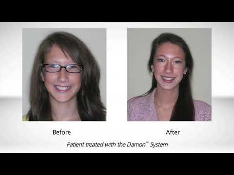 Damon Braces for Teens