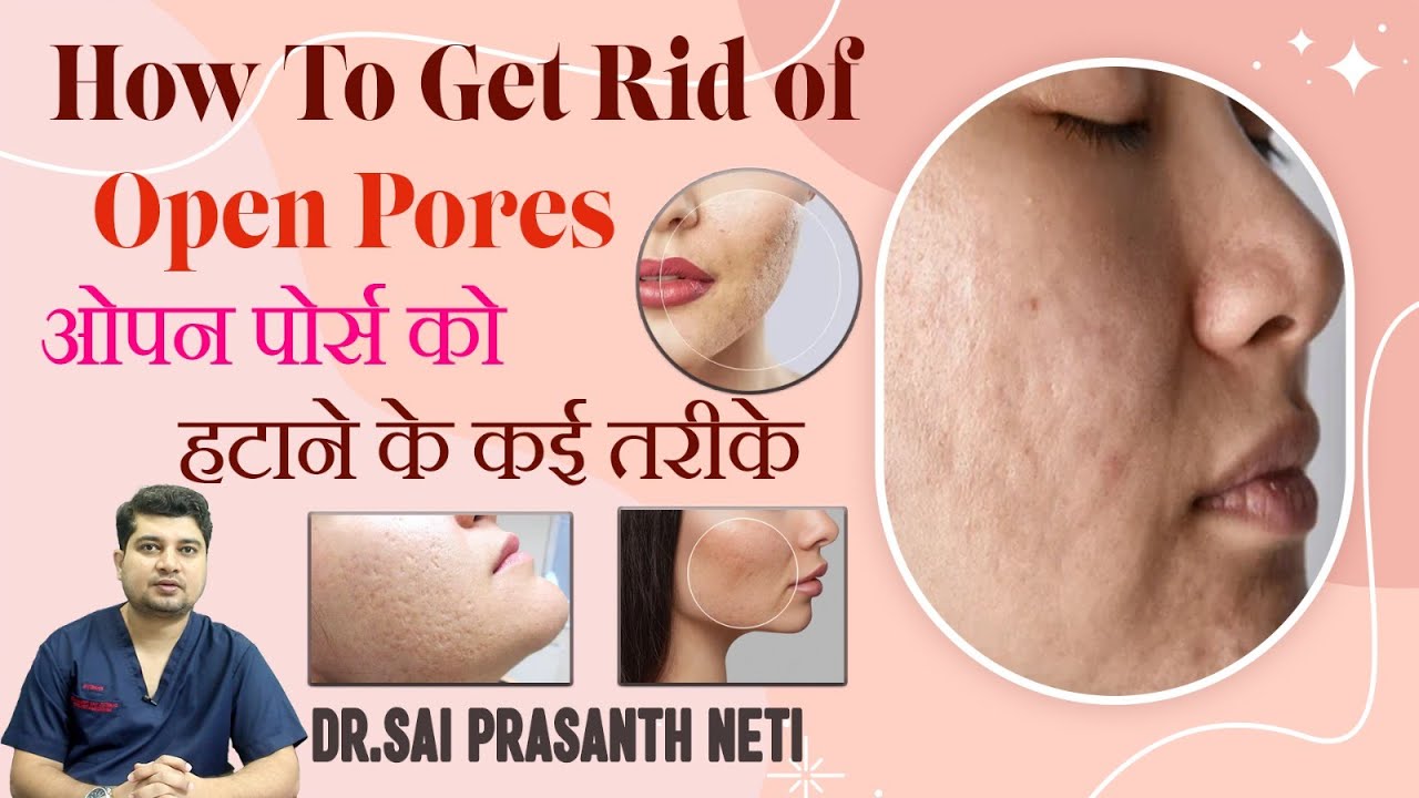 How to get Rid of Open Pores || OPEN PORES SOLUTION || Dr.Sai Prasanth ...
