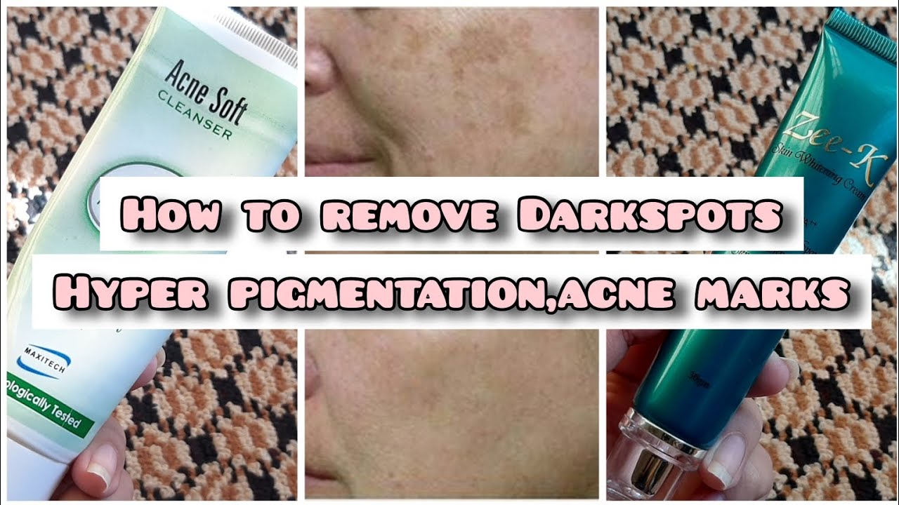 How To Remove Darkspots,Hyper pigmentation And Acne Marks - YouTube