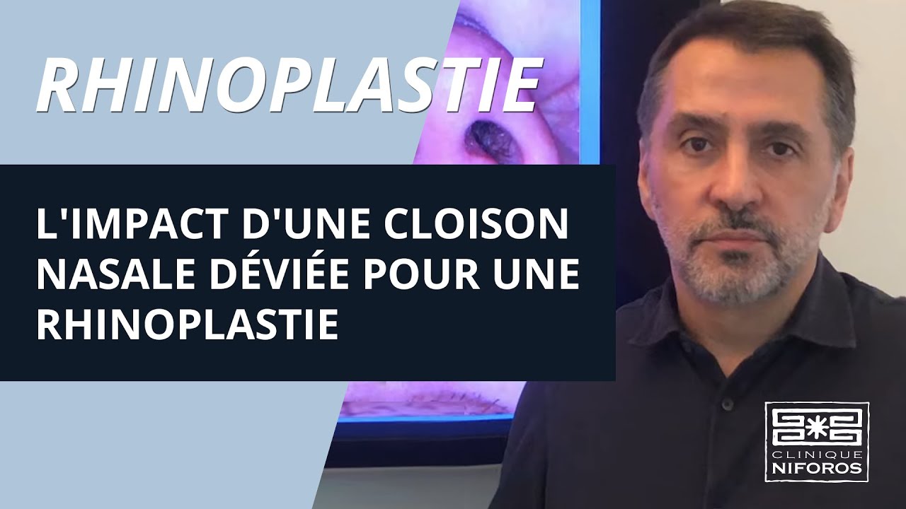 L'impact d'une cloison nasale déviée pour une rhinoplastie - YouTube