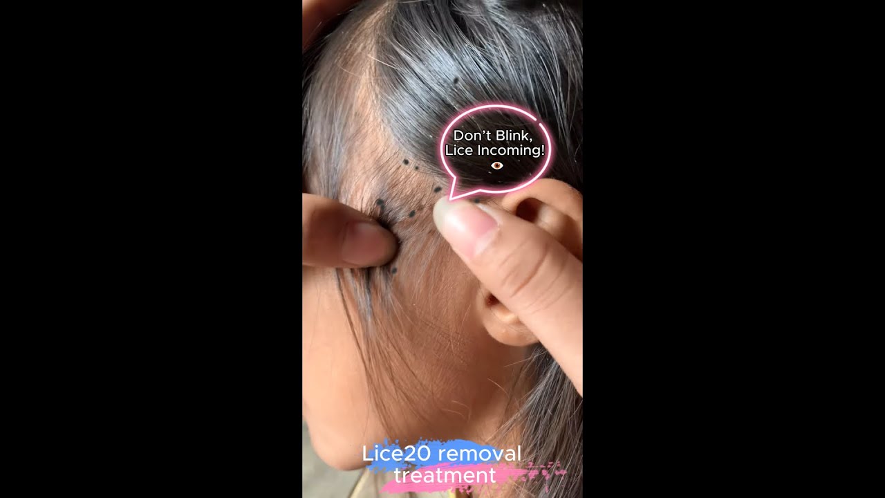 (Part 08) Lice Removal & Treatment Satisfying Lice Popping - YouTube