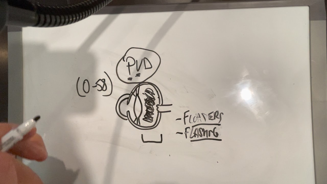 Posterior Vitreous Detachment - PVD: Patient Educational Video - YouTube