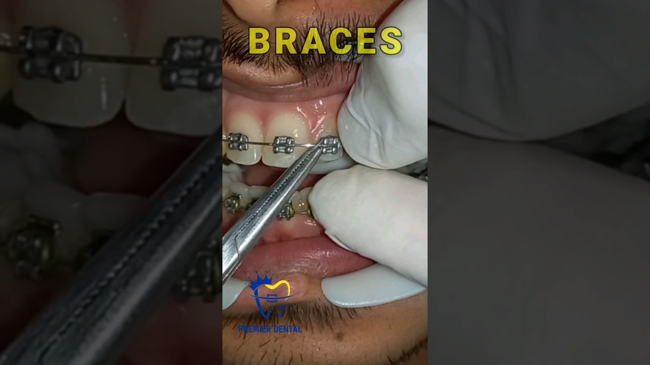 Braces / modules used to secure wire within bracket - YouTube