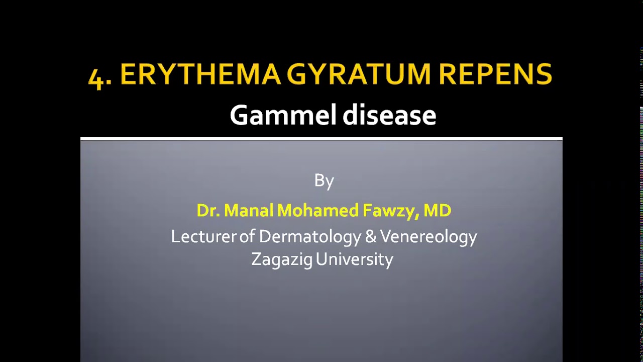 Figurate erythema (4- erythema gyratum repens) - YouTube