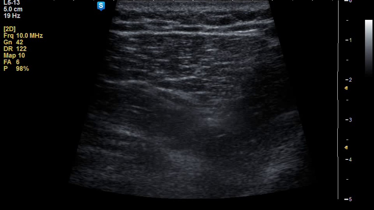 Ultrasound guided Injection of the Axillary nerve - YouTube