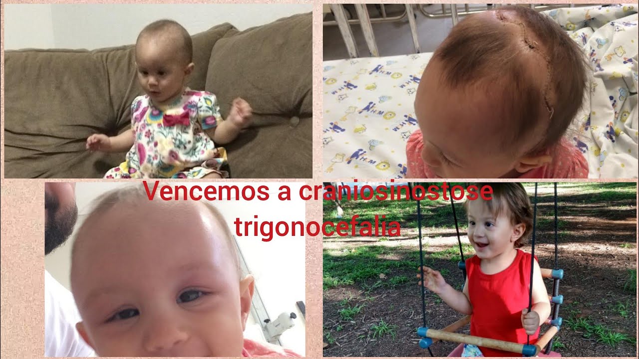 vencemos a craniosinostose trigonocefalia! (1 ano pós cirúrgia) - YouTube