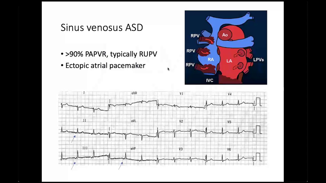 Atrial Septal Abnormalities - YouTube