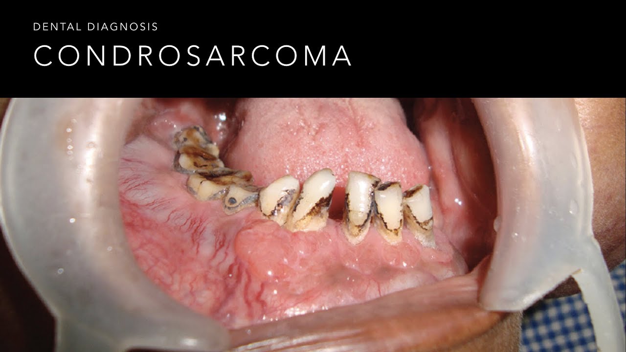 Condrosarcoma - YouTube