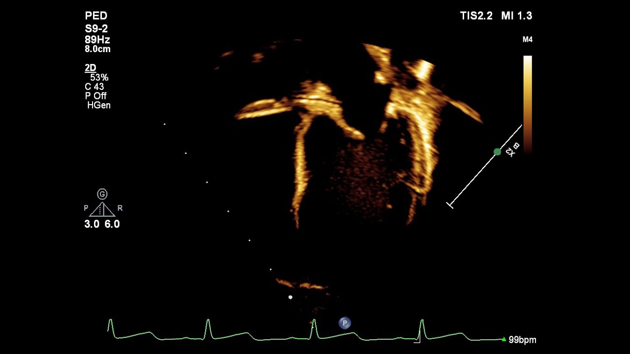Basic echocardiography(심장 초음파 기본)- LCX from RCA (Left circumflex artery ...