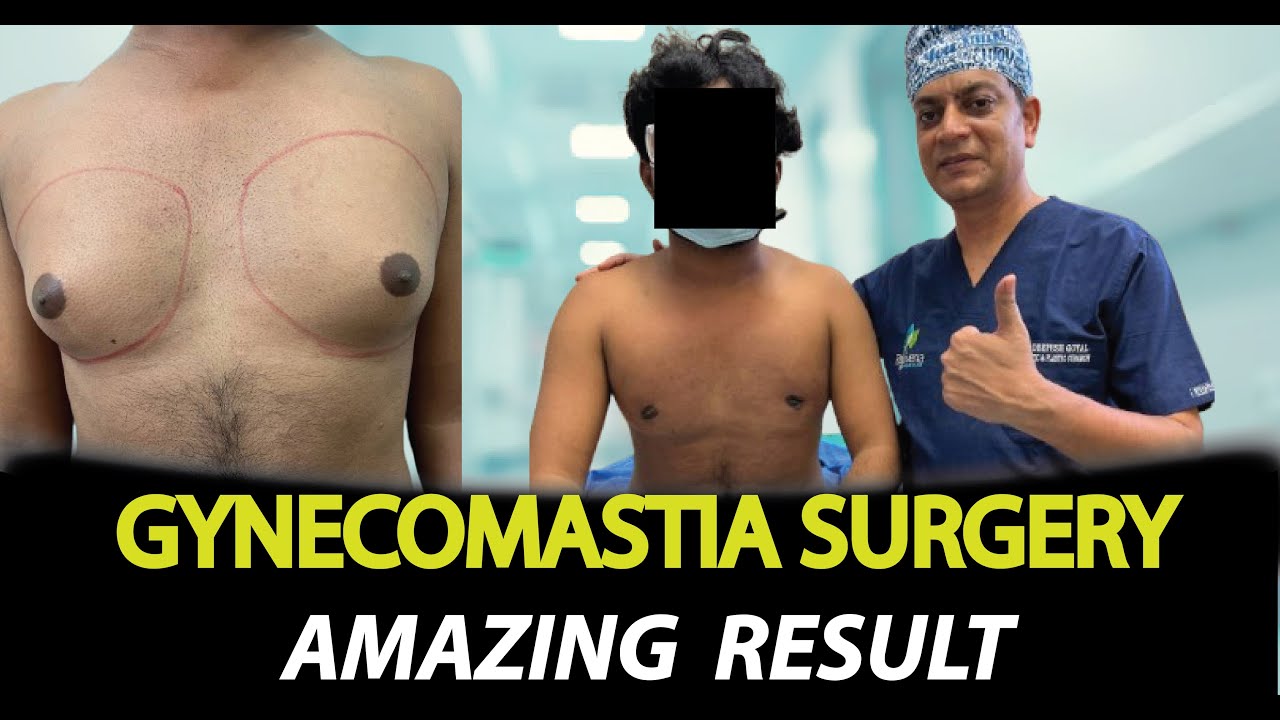 Gynecomastia Surgery in Madhya Pradesh | Male Breast Reduction | Dr. Deepesh Goyal - YouTube