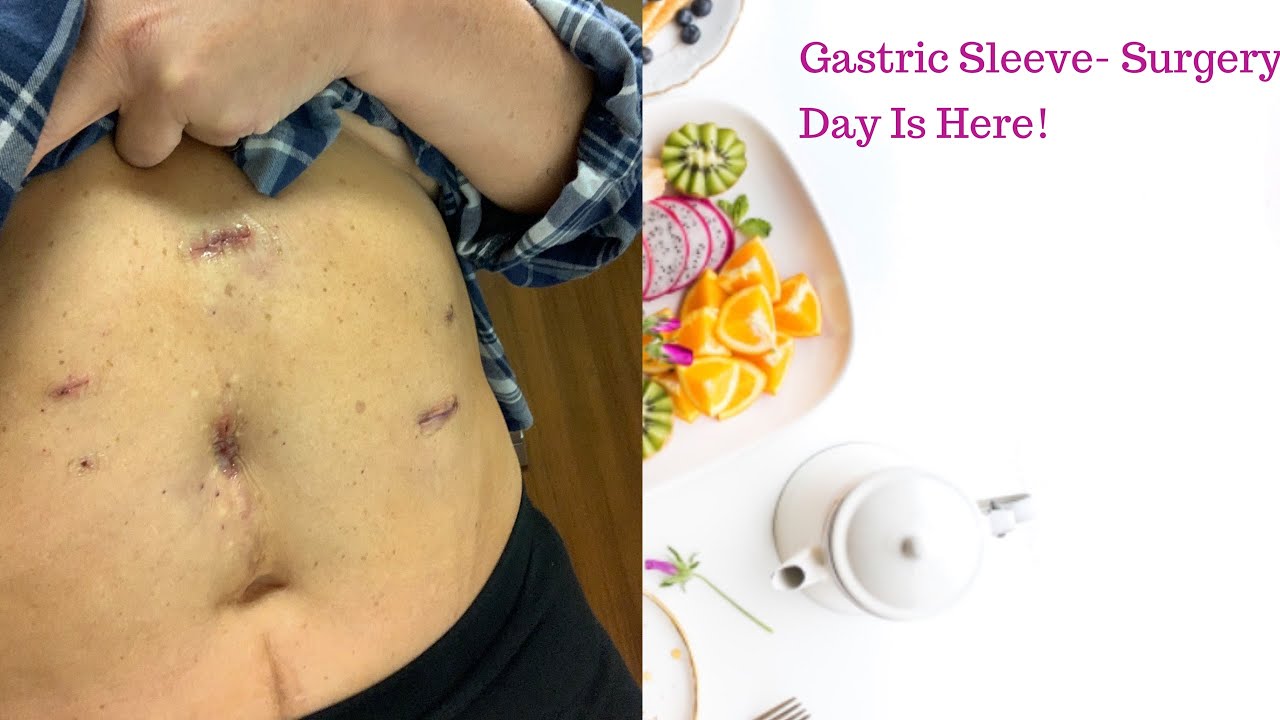 Vsg Gastric Sleeve 2019 Surgery Day Youtube