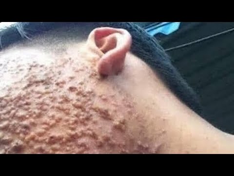Most Satisfying White Heads Removal | Satisfying Black Heads Removal ...