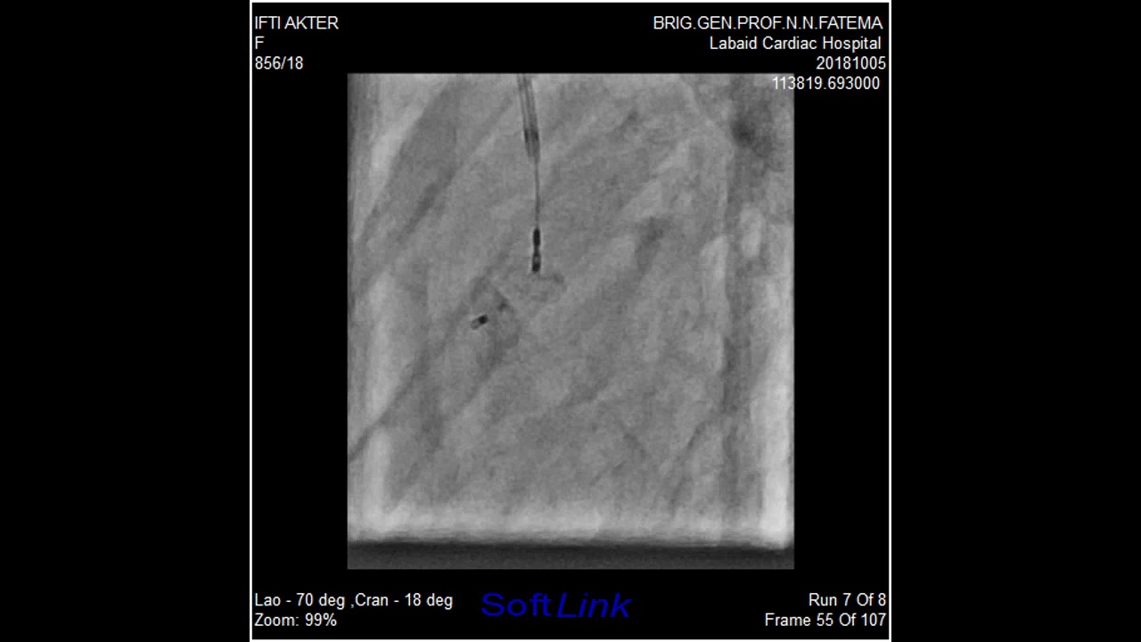 Ifti Akter Small PM VSD Device closure done by 6 x 4 MFO Device - YouTube