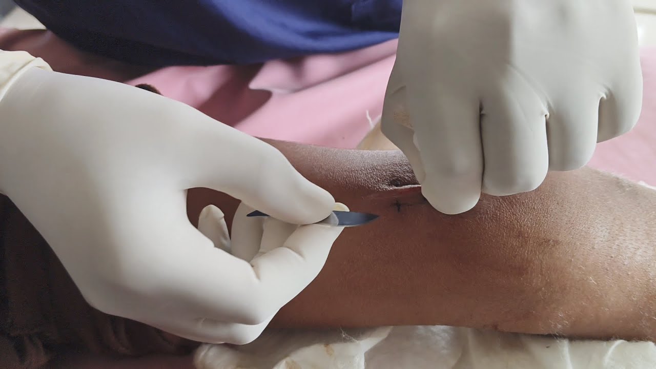How to Remove Stitches After Surgery | Hindi Guide । Doctor & Nursing Vlogs - YouTube