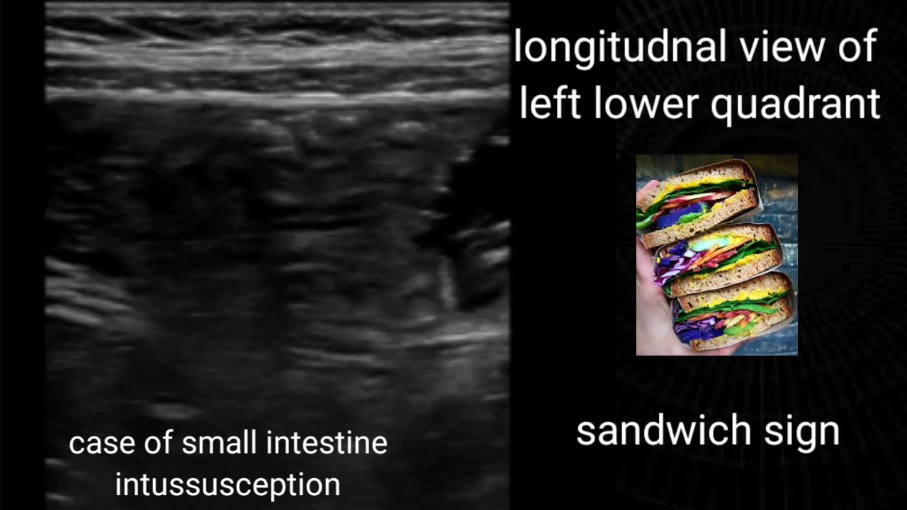 Case of small intestinal intussusception/ultrasound cases - YouTube