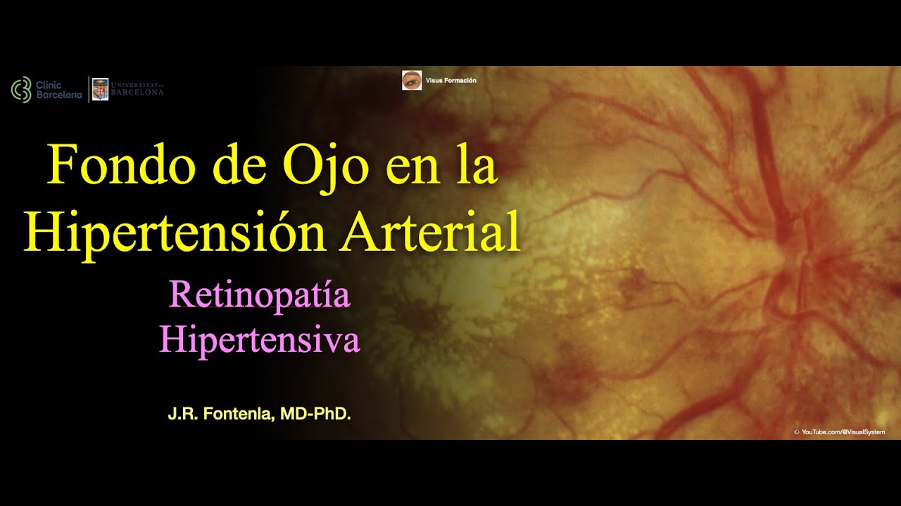 Fondo de Ojo en la Hipertensión Arterial. Retinopatía Hipertensiva ...