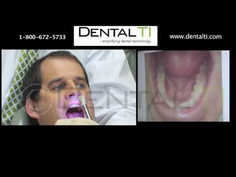 Dental TI : 1 Minute Exam ( Intraoral camera)