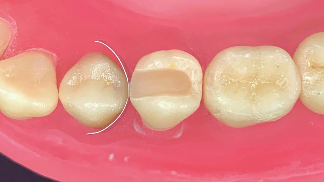 Preparo para inlay - YouTube