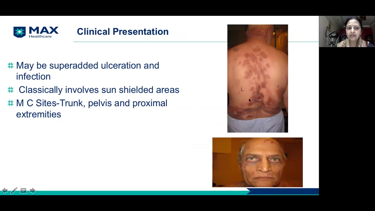 Total Skin Electron Therapy (TSET)_Dr Vineeta Goel - YouTube