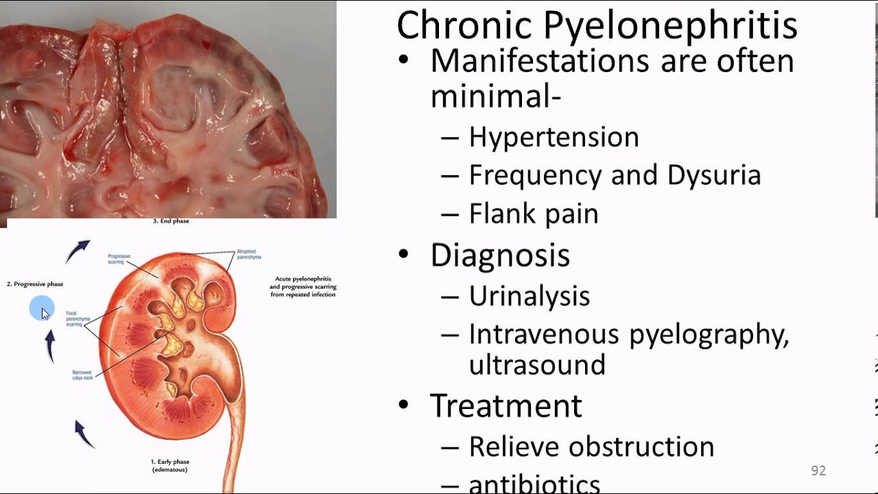 Pathophysiology Renal 3 UTI Acute And Chronic YouTube Pathophysiology Renal 3 UTI Acute And Chronic YouTube