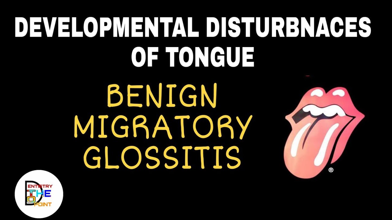 DEVELOPMENTAL DISTURBANCES OF TONGUE- BENIGN MIGRATORY GLOSSITIS - YouTube