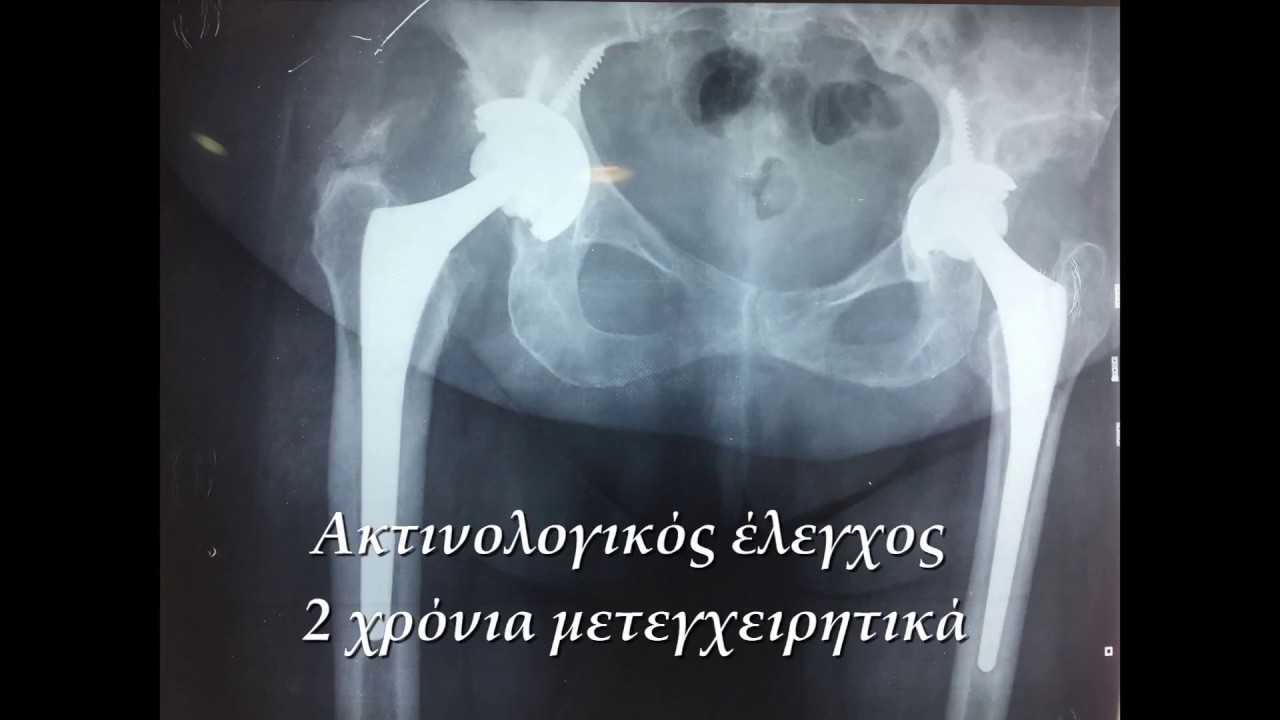 Συγγενές εξάρθρημα ισχίου (αμφο) - Βάδιση 2 έτη μετεγχειρητικά - Δρ. N ...