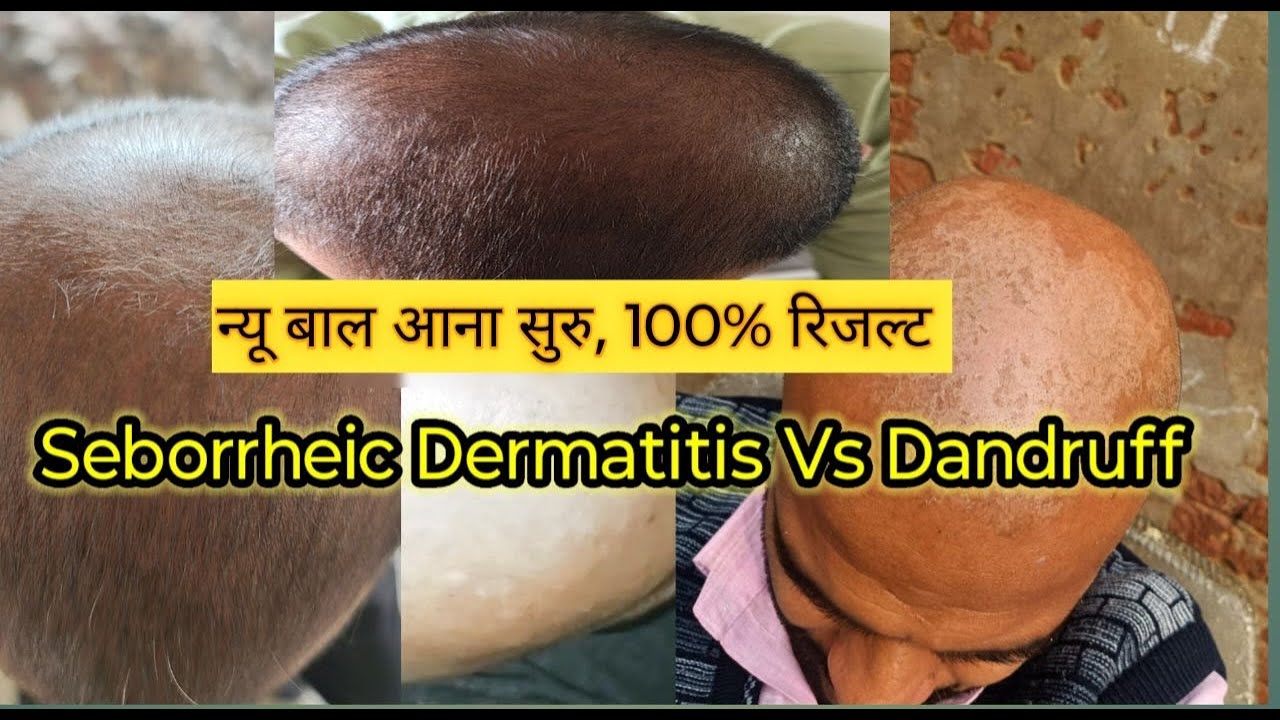 seborrheic dermatitis vs dandruff,seborrheic dermatitis scalp ...