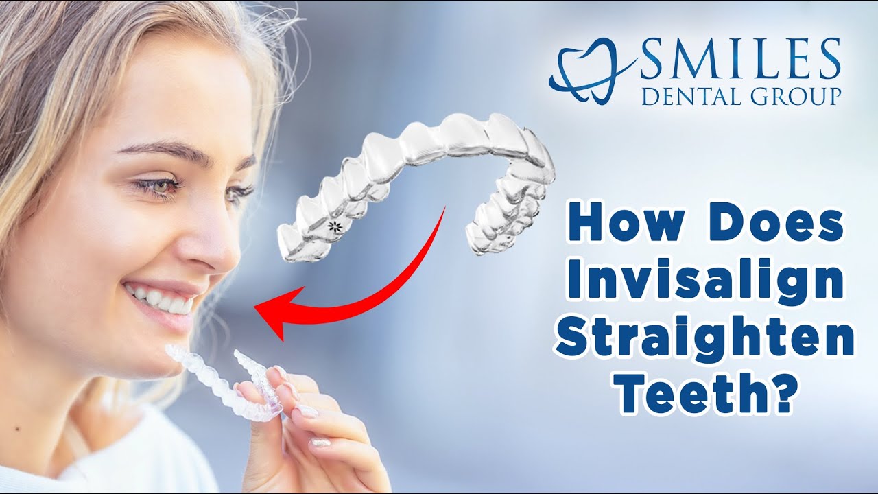 What is Invisalign? How Does It Straighten Teeth? - YouTube