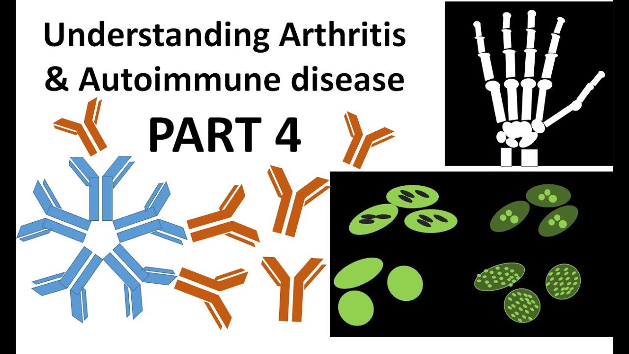 Part 4 of 7 Understanding arthritis: Vasculitis - GCA, PAN, Immune ...