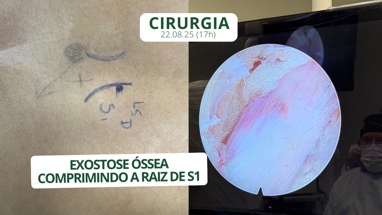 Exostose óssea comprimindo a raiz de S1 | 22.08 25 (17h) - YouTube