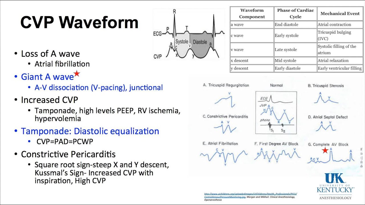 Understanding CVP Waveforms Yale School Of Medicine, 46% OFF