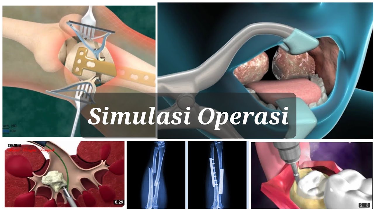 BEGINI!! PROSES OPERASI (Simulasi) - YouTube