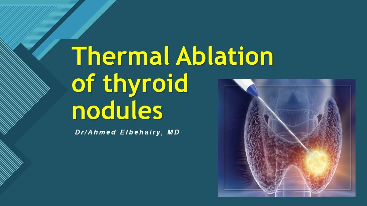 Thermal Ablation of Thyroid Nodules - YouTube