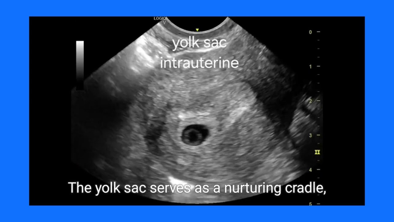 Ovarian Cyst Ultrasound In Early Pregnancy The Radiology Assistant