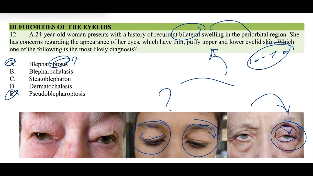 Blepharochalaisa Vs Dermatochalasia - YouTube