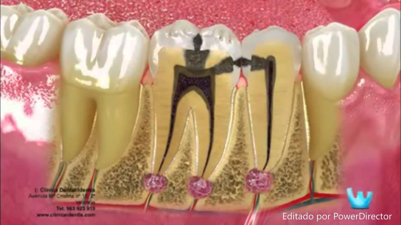 Necrosis Pulpar y Circulación Sanguínea - YouTube