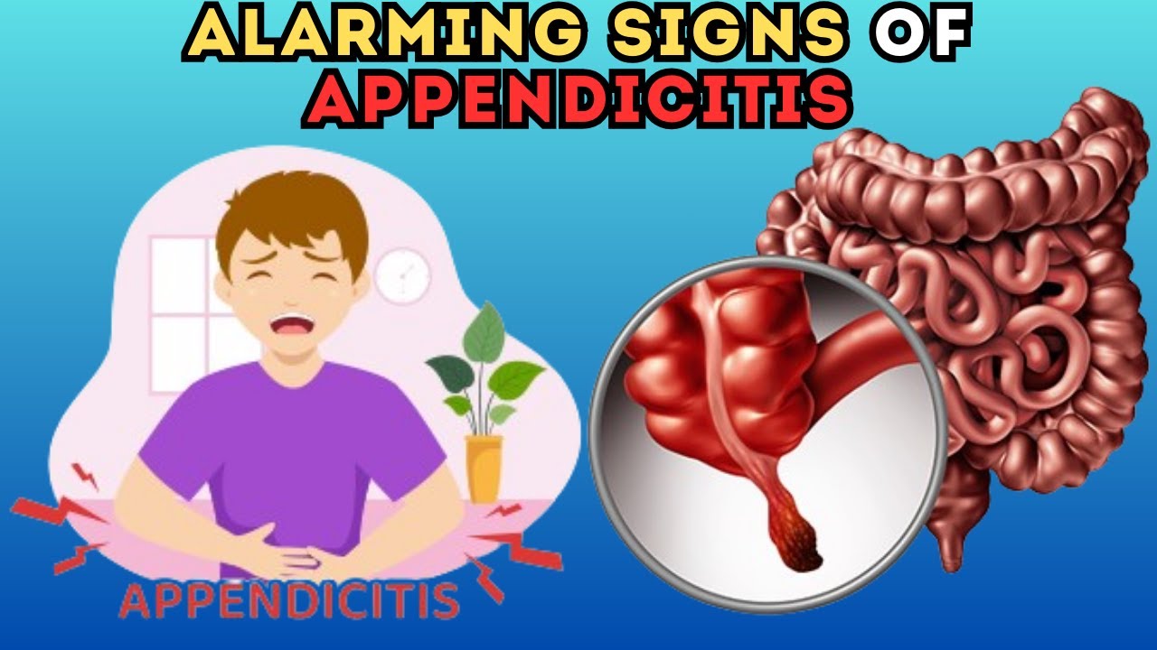 Identify Early Signs of Appendicitis | Appendicitis Symptoms - YouTube