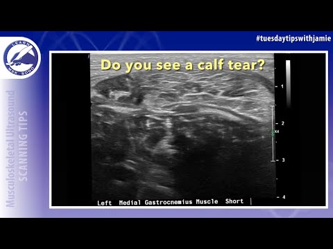 Technique for visualizing a calf tear on ultrasound - YouTube