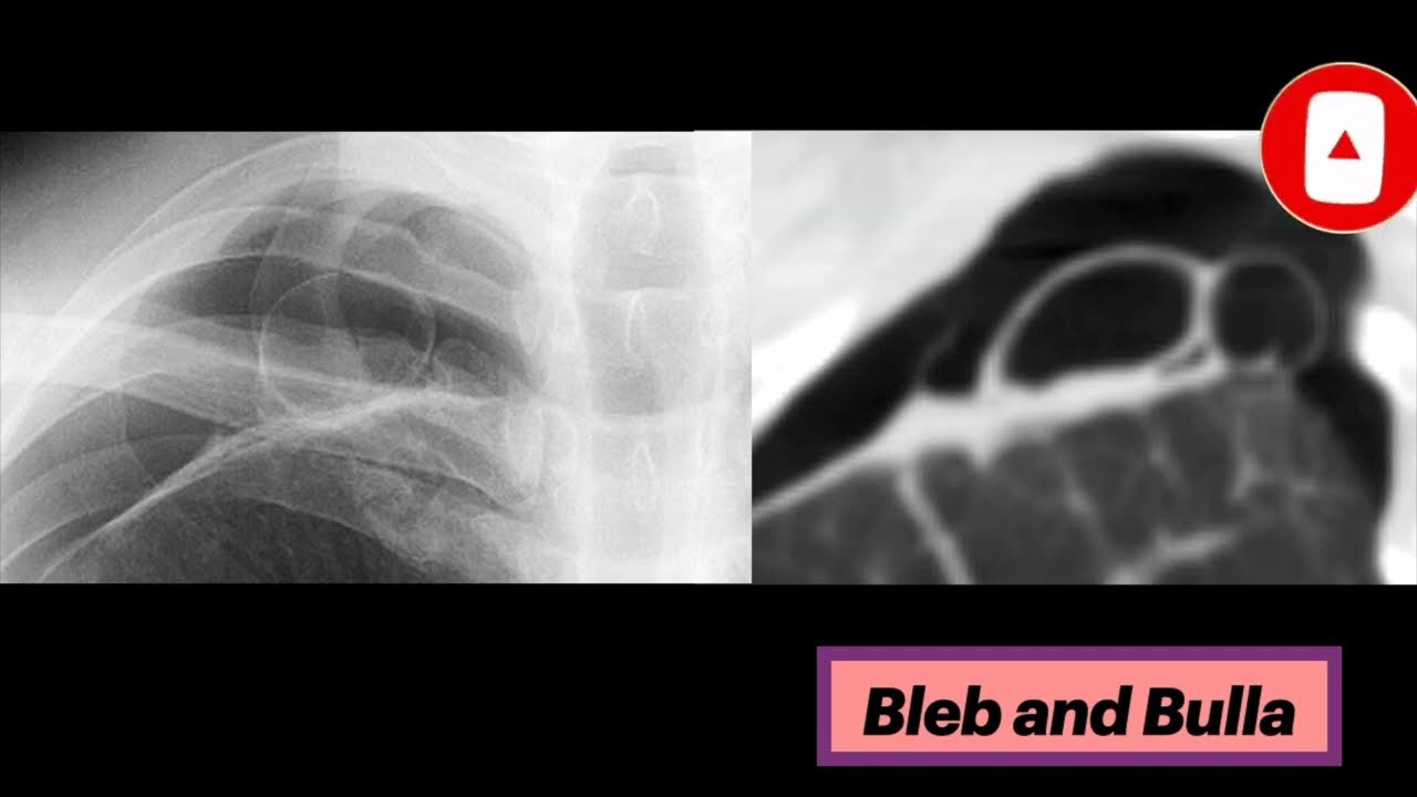 Blebs and Bullae #radiology #thoracicsurgery #pulmonology - YouTube