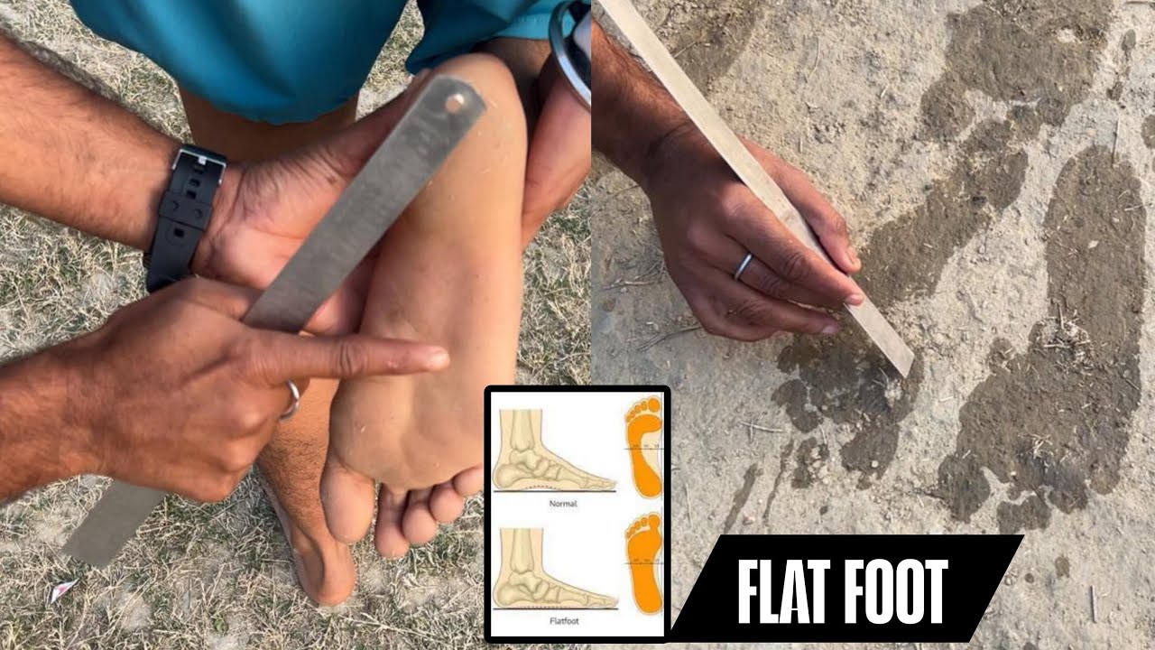 Flat Foot Medical Test | Flat Foot Kya Hai Medical Test Flat Foot 2025 ...