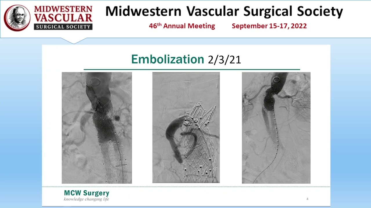 Coil Embolization of Persistent type 1a endoleak - Midwestern Vascular ...