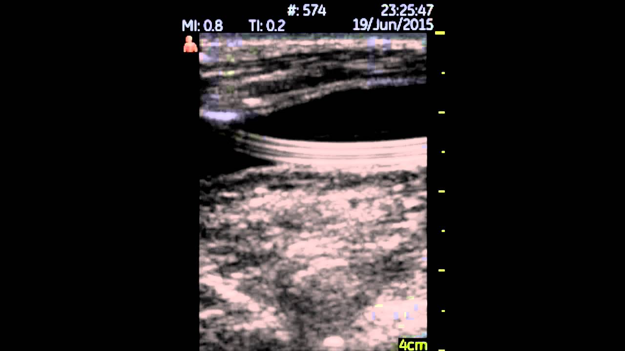CVC insertion_ real-time guidance and confirmation under pocket-sized ...