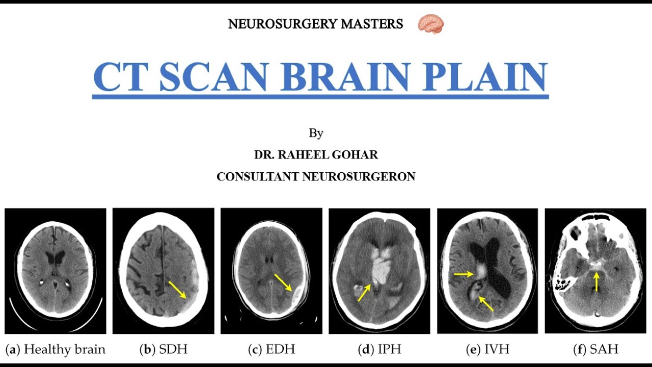 CT Scan Brain Plain - Orientation, Anatomy and Pathologies - Part 1 ...