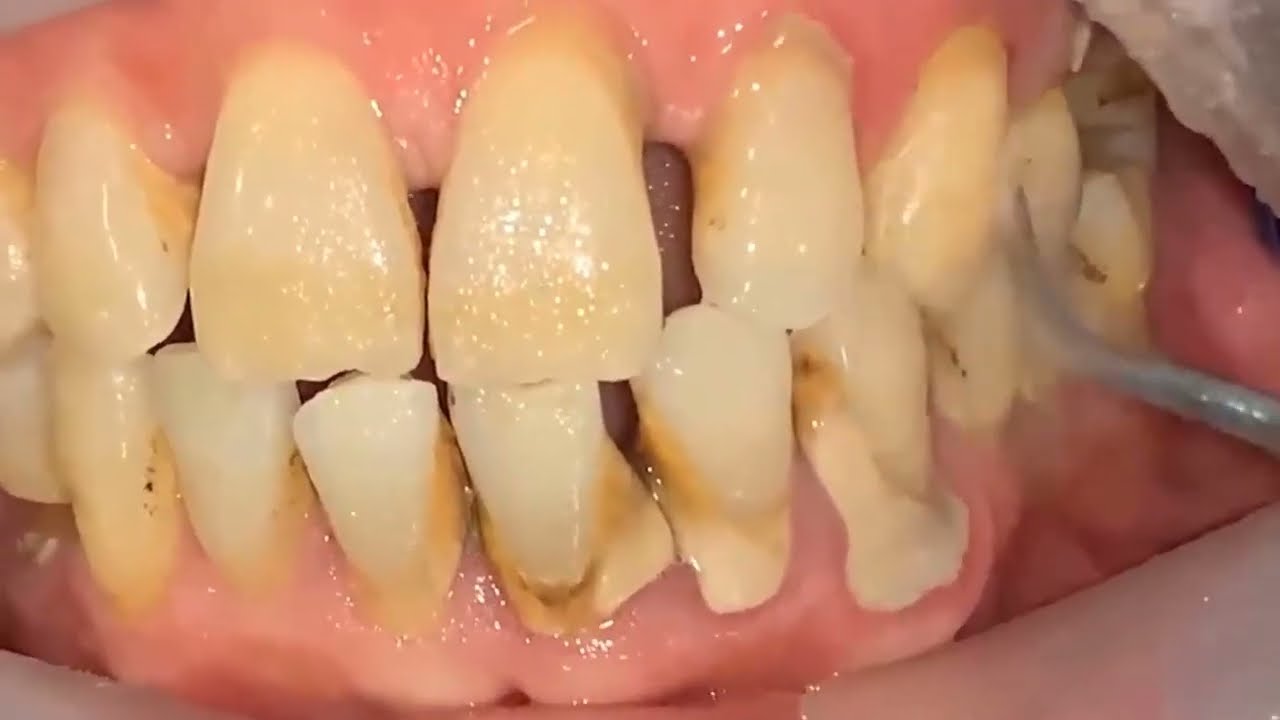 ASMR Teeth Cleaning - TARTAR & CALCULUS Removal and Deep Cleaning - YouTube