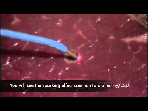 Inservice Demo: Ellman RF Fulguration - YouTube