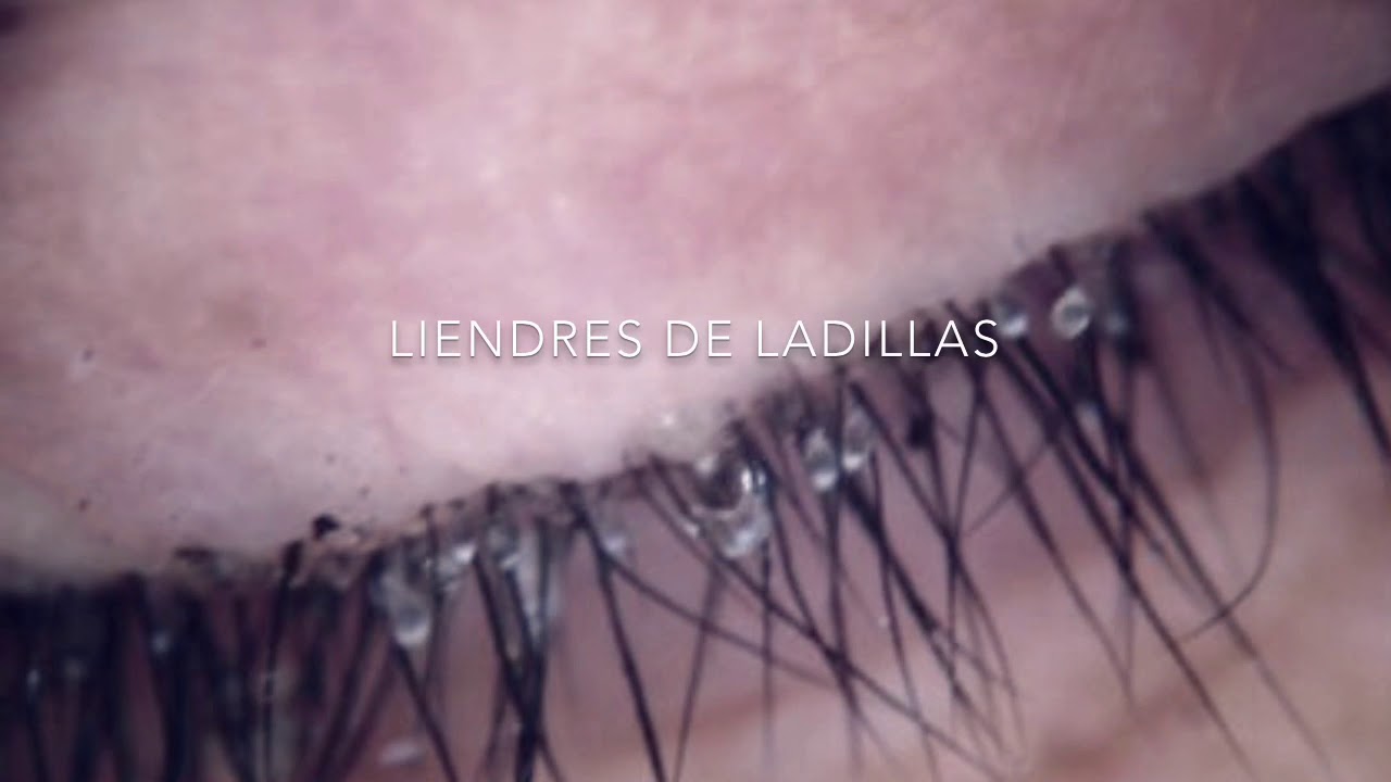 Diferencia entre Piojos Púbicos Y Piojos De La Cabeza - YouTube